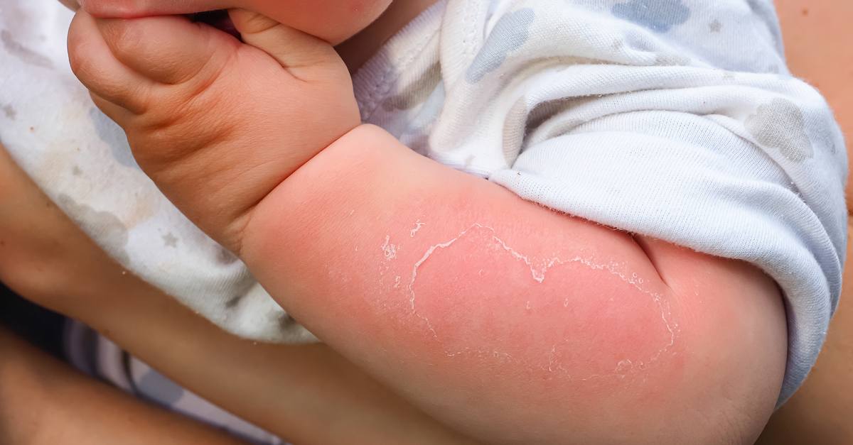 Trẻ 1 Tuổi Bị Bỏng Nước Sôi Cách Xử Lý Nhanh An Toàn Cho Bé